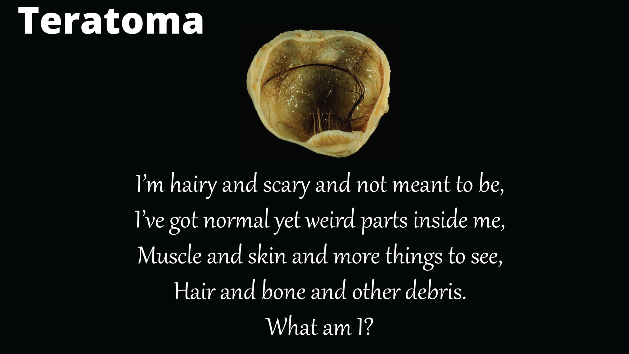 What are Teratomas? Pathophysiology, Types, Symptoms, Investigations ...